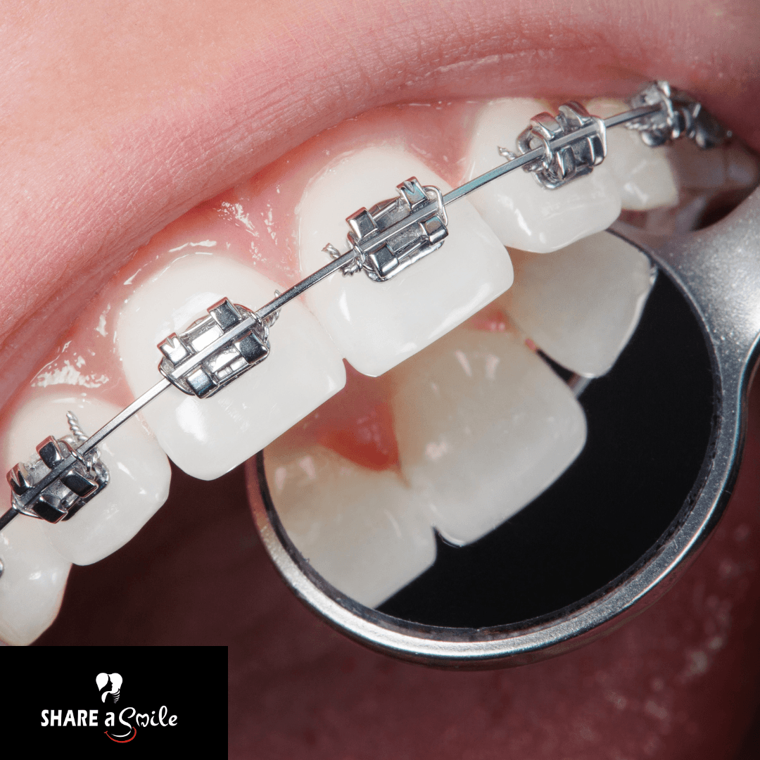 Straightening Smiles: Orthodontic Treatment for All Ages