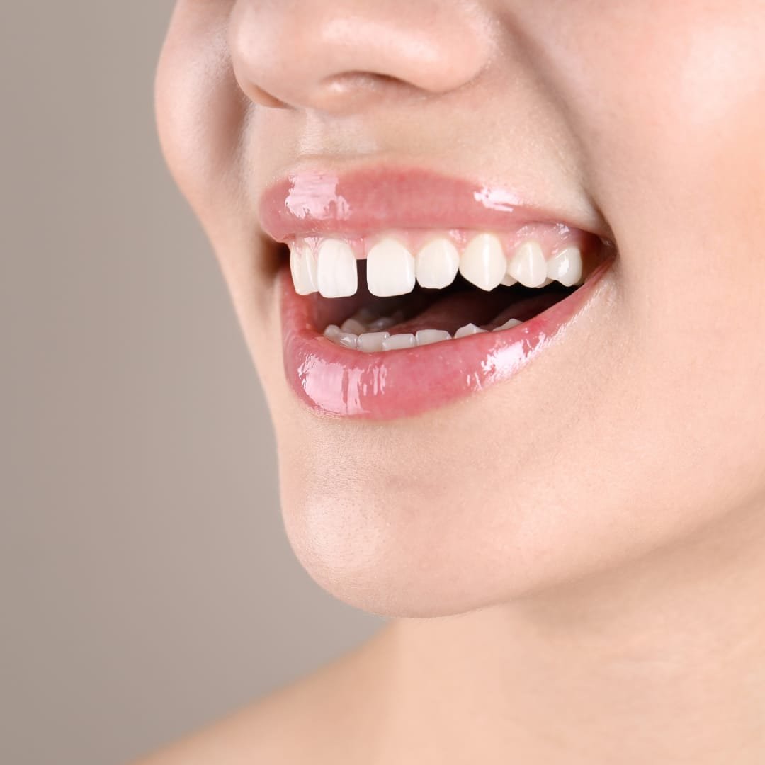 Gaps Between Teeth - Share A Smile